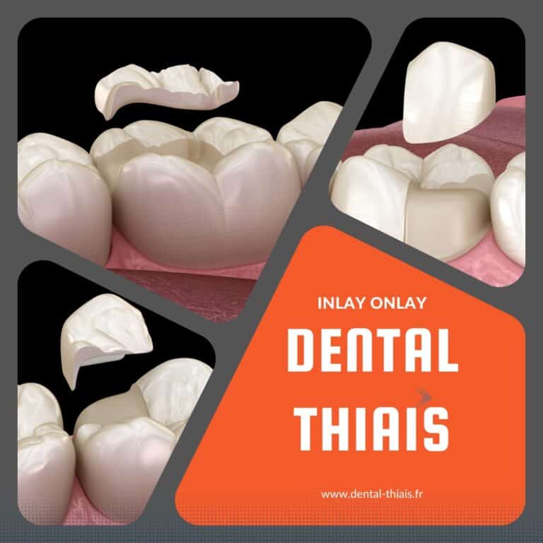 Inlays et Onlays : Tout savoir sur ces techniques dentaires de restauration