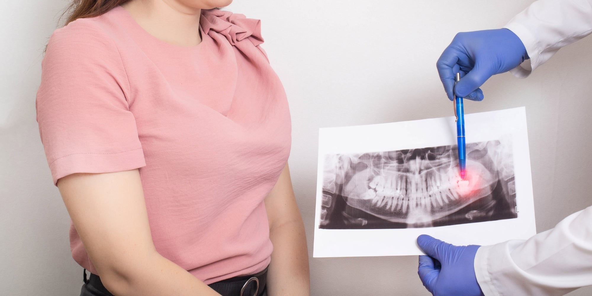 Dents de Sagesse : Tout savoir et comprendre avec notre guide
