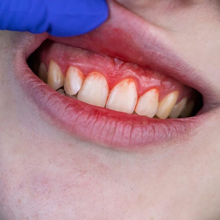 Comprendre les incisives : Rôle essentiel et gestion des problèmes ...