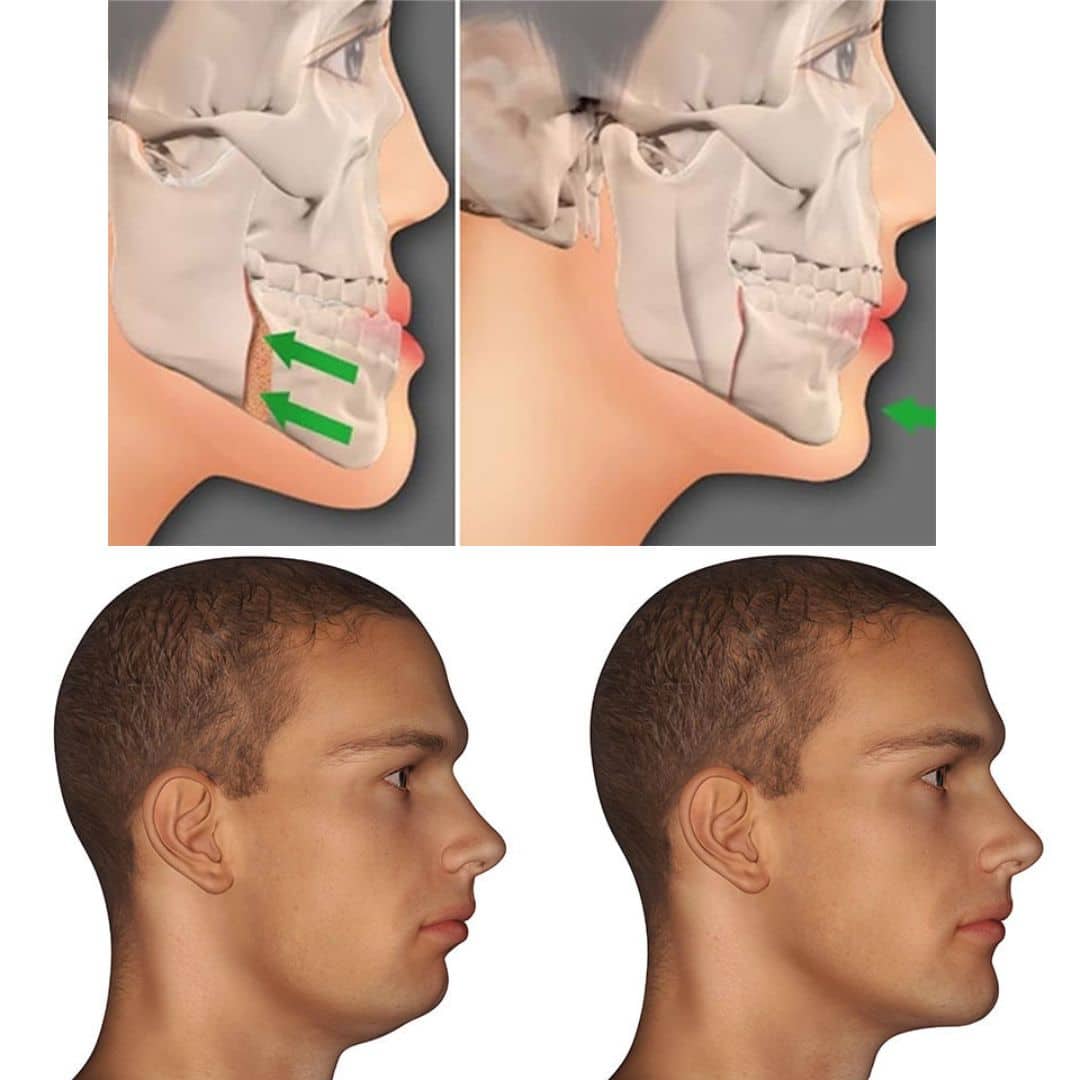 Comprendre les incisives : Rôle essentiel et gestion des problèmes ...