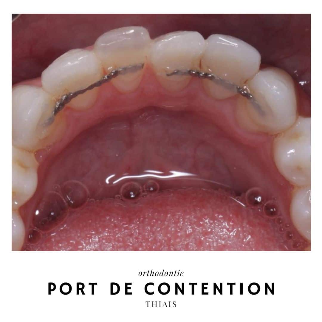 Pourquoi le Port de Contention Orthodontique est Indispensable après un ...